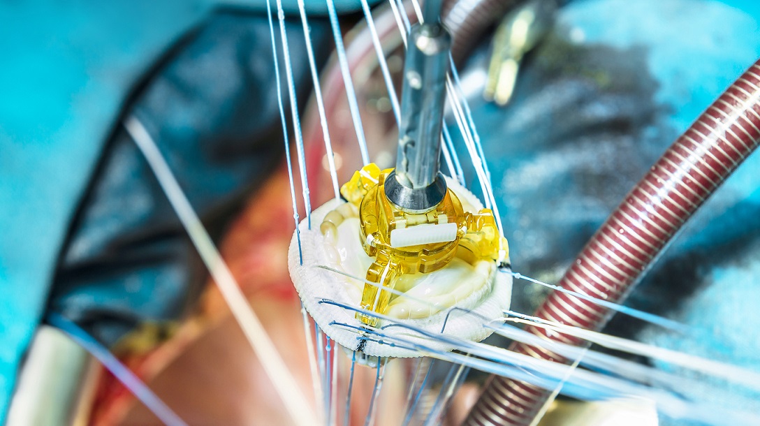 Structural Heart Devices - Engineering Development and Manufacturing ...